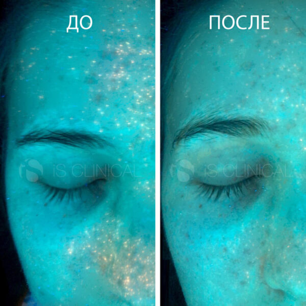 PRODIGY PEEL PRO (P3) SYSTEM - iS CLINICAL®